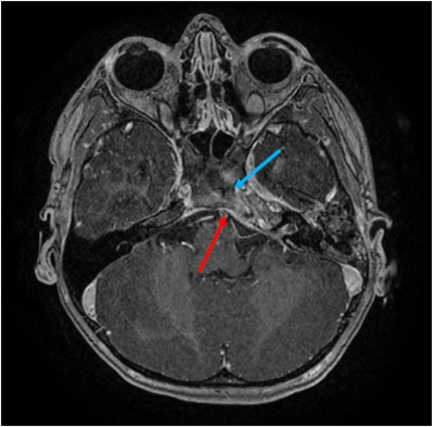 "Gradenigo syndrome: A rare complication of otitis media" by Paul Ferguson